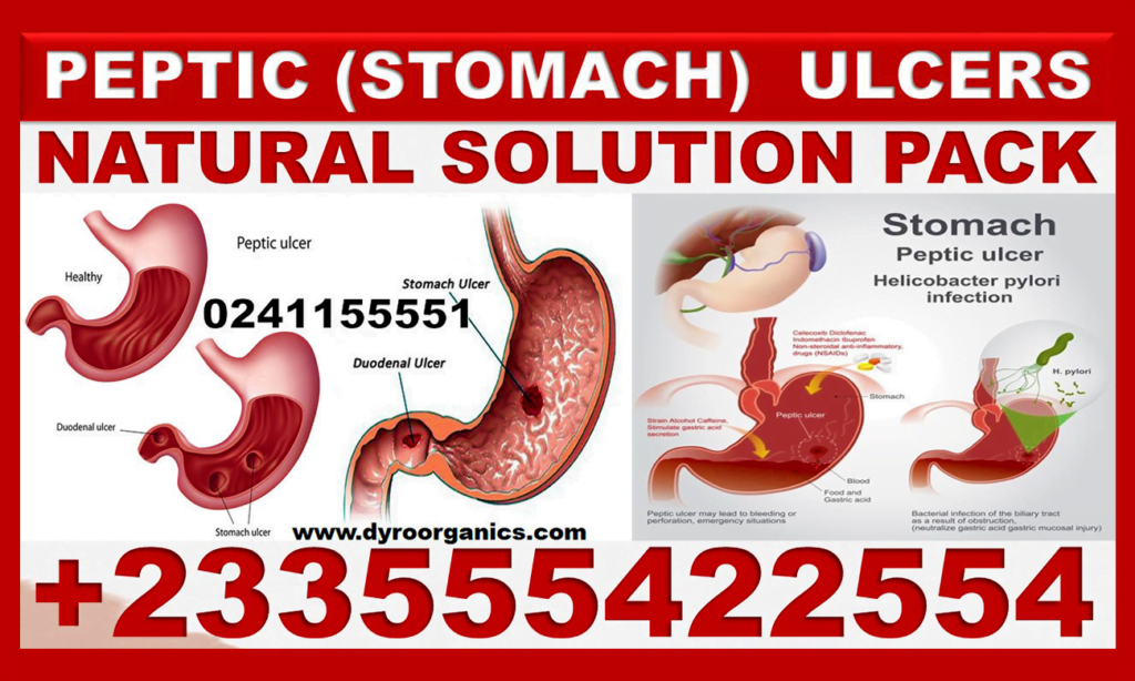 Pills for Stomach Ulcer in Ghana Accra Kumasi Tamale